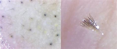 코에 박힌 검은 점 알고보니 ‘털 뭉치라고