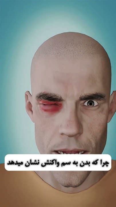 حمله زنبور به چشم Youtube