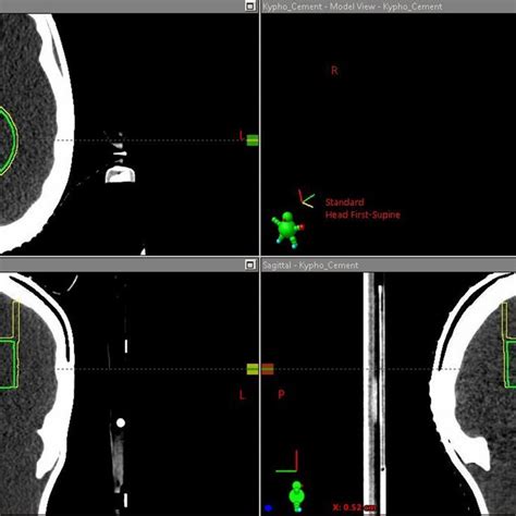Screenshot From The Eclipse Tps Showing The A16 Micro‐chamber Insert