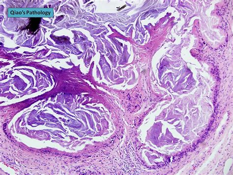 Flickriver Photoset Gouty Tophi By Qiaos Pathology Art And Science