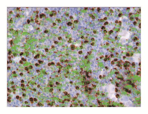 Elevated Foxp3 Cd8 Ratio In Lung Adenocarcinoma Metastatic Lymph Nodes