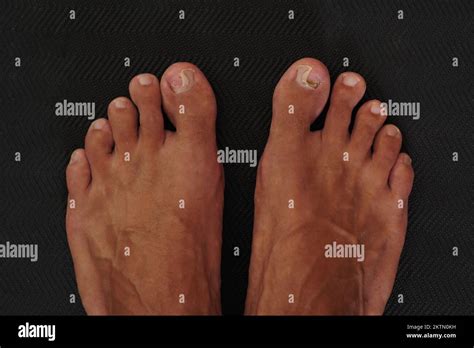 Toenail Peel Away With Parts Splitting Or Broken Off Cracked Nail