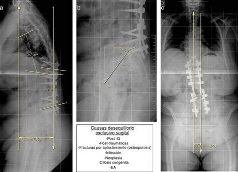 Alteraciones De La Alineación Vertebral Radiología