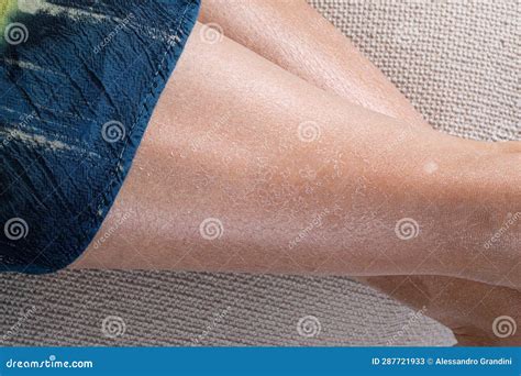 Female Legs With Dry Skin Stock Image Image Of Dermatitis 287721933
