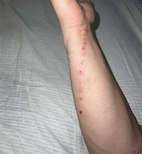 Linear Scabies R Scabies