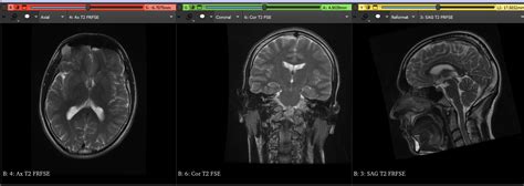 Combining Different Segmentations Support 3d Slicer Community