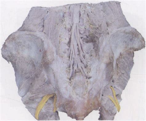 图11 82 坐骨神经 1 临床应用人体结构