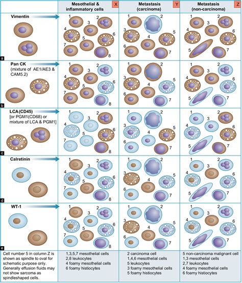 Immunocytochemistry Of Effusion Fluids Introduction To Scip Approach Cytojournal
