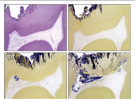 Figure 3 From Correlation Between Clinical And Histologic Pulp Diagnoses Semantic Scholar