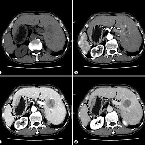 Intraoperative Photography Of The Right Hemihepatectomy Of Hcc Patients Download Scientific