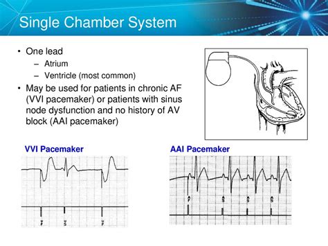 Types Of Pacemakers Online Presentation
