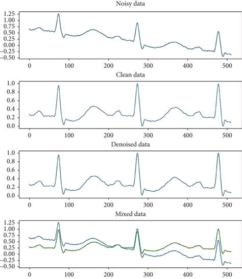 The Effect Of Removing Three Types Of Single Noise In The Ecg Signal
