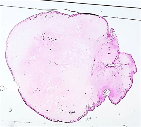 Histopathology Is Suggestive Of Cemento Ossifying Fibroid Epulis