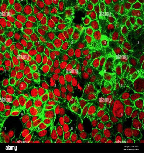 Les cellules du cancer du côlon La lumière de fluorescence de