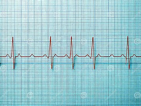 Understanding Single Chamber Atrial Pacemaker Ecg Rhythm An 8second