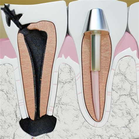 Teeth Pathologies Tooth 3d 3ds