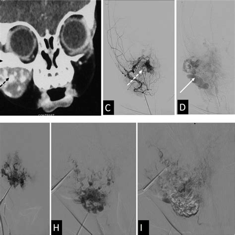 Avm Classification By Yakes Et Al 9 Download Scientific Diagram