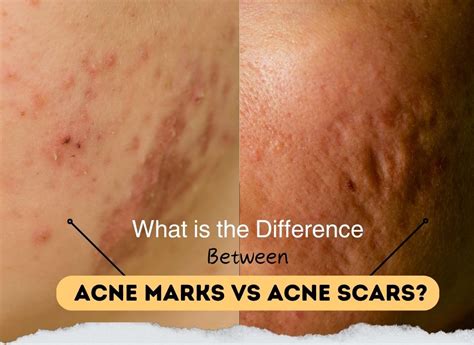 What Is The Difference Between Acne Marks Vs Acne Scars