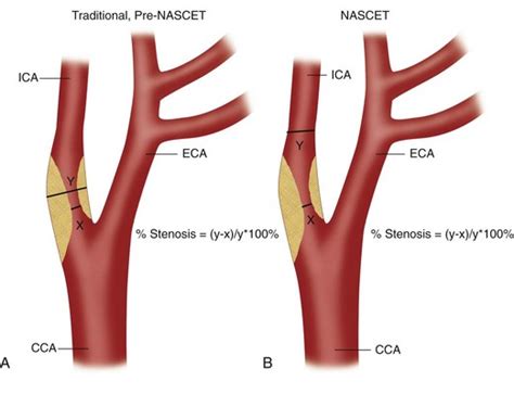 Ultrasound Evaluation Of The Carotid Arteries Radiology Key