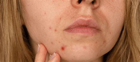 Boil Vs Pimple Know The Difference Between A Boil And Pimple The
