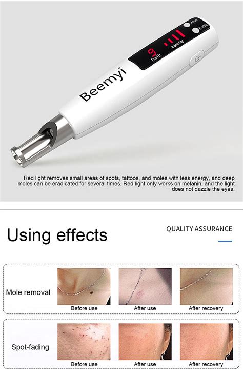 가정용 레이저 문신 제거 Picosecond Pen 의 고품질 가정용 레이저 문신 제거 Picosecond Pen