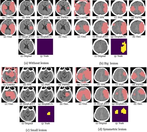 Sfcn Symmetric Feature Comparison Network For Detecting Ischemic Stroke Lesions On Ct Images