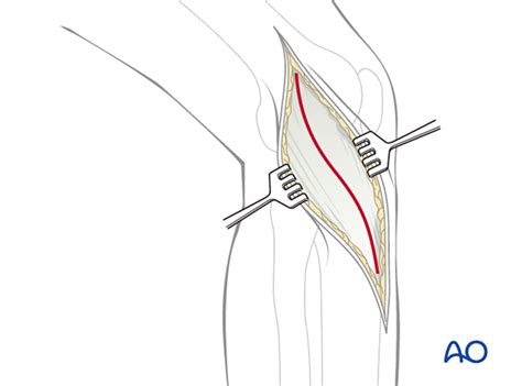 Anterolateral Approach To The Proximal Tibia
