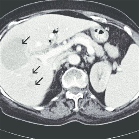 Photomicrograph Showing Atypical Infiltrating Plasma Cells And Effacing