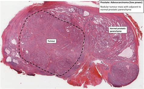 Prostate Prostatic Carcinoma Nus Pathweb Nus Pathweb