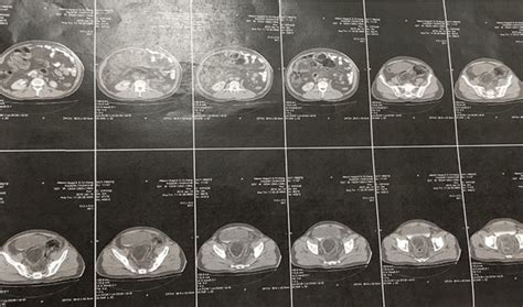 Spiral Abdomino Pelvic Ct Scan Download Scientific Diagram
