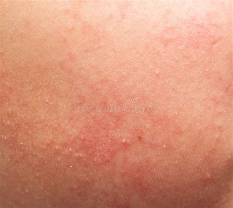List 93 Pictures Photos Of Allergic Skin Rashes Full Hd 2k 4k