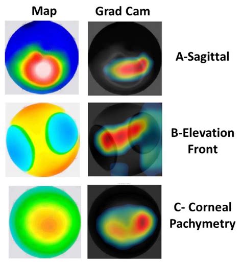 a deep feature fusion of improved suspected keratoconus detection with