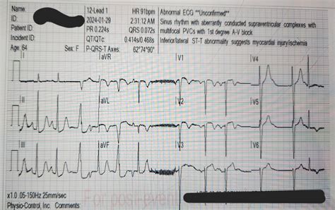 there s weird squiggles on this squiggle chart tell me why r ecg