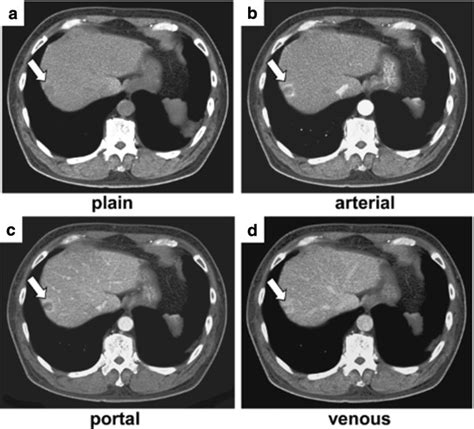 Abdominal Contrast Enhanced Dynamic Computed Tomography Ct Findings