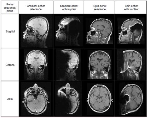 Figure 10 The Mri Images In Three Orthogonal Planes Sagittal Coronal
