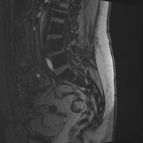 I Had An Mri After Being Told I Have A Pars Defect And Need A Fusion R Spinesurgery