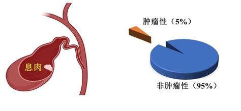 胆囊息肉严重吗？ 微医（挂号网）