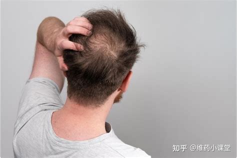 【男性脱发】中医有三种证型，教你掌握养发关键！ 知乎
