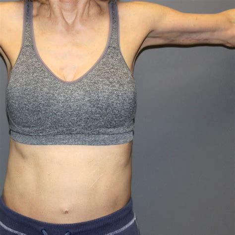 Brachioplasty Archives Dr Lee B Daniel