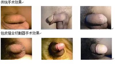 包皮环切器 新型包皮手术神器 包皮环切术 好大夫在线