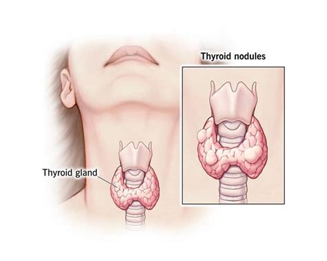 Thyroid Nodule Ablation Rgp Vein Clinics