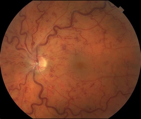 Retinal Vein Occlusion Professional Product By Vitreous Retina Macula