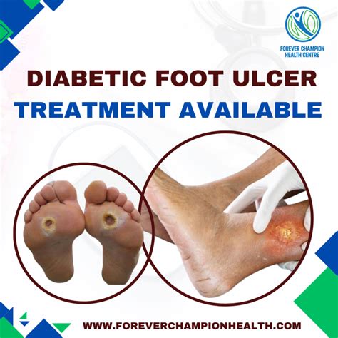Diabetic Foot Ulcersore Forever Champion Health Centre