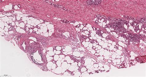 Calciphylaxis Causing Skin Gangrene In An Old Woman With End Stage