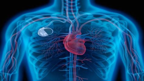 Who Are The Leading Innovators In Cardiac Stimulation Implants For The Medical Devices Industry