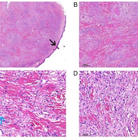 Patient 5 A A Well Circumscribed Lesion Located At The Dermis