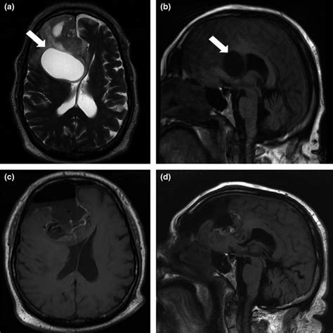 A T2‐weighted Axial And B T1‐weighted Sagittal Preoperative