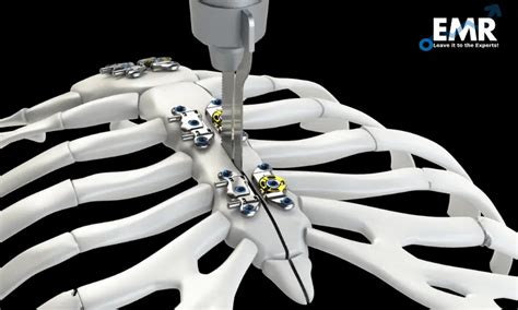 Top 6 Sternal Closure Systems Companies In The World