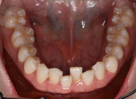 Orthodontic Relapse In Adults