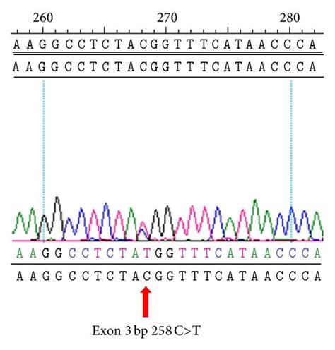 Chromatograms Of One Patient With Pathogenic Exon 3 Mutation An Arrow Download Scientific